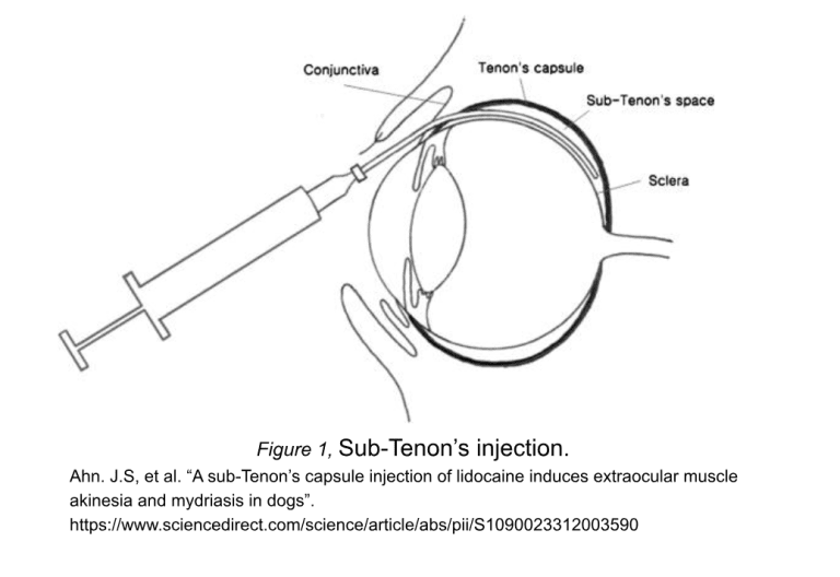 The Sub-Tenon Block: Technique, Advantage and Complications – The ...